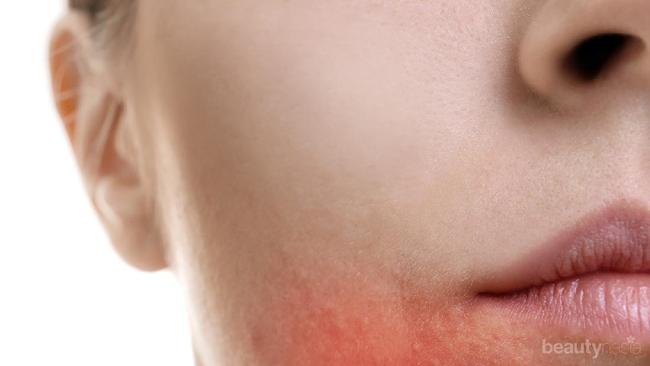 Tips Rawat Kulit Berminyak dan Sensitif yang Perlu Kamu Ketahui