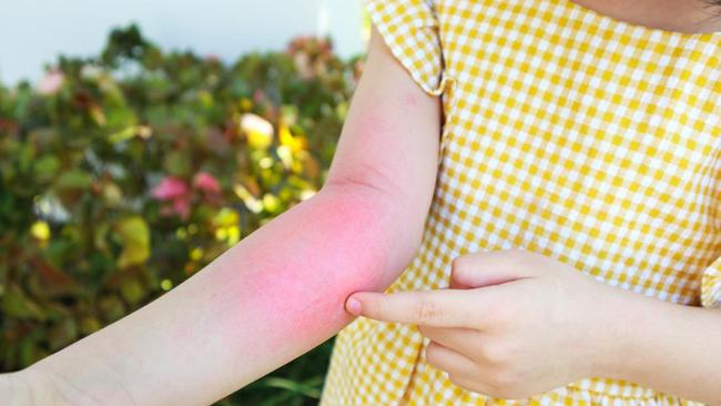 4 Tanda Si Kecil Alergi Telur, Mulai dari Gatal-gatal hingga Batuk