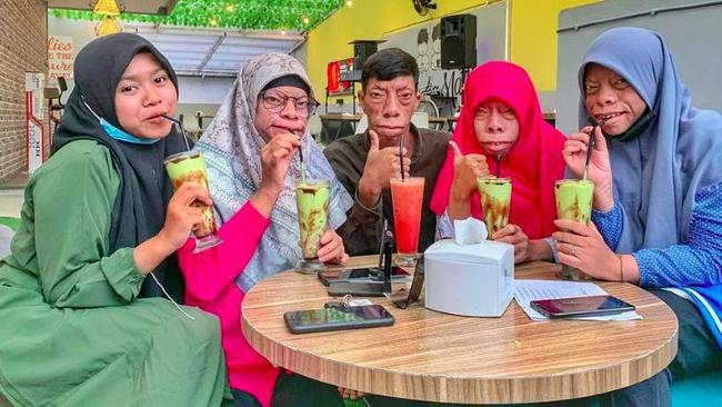 Cerita Keluarga di Asahan Idap Sindroma Langka, Hanya Ada 25 Orang di Dunia