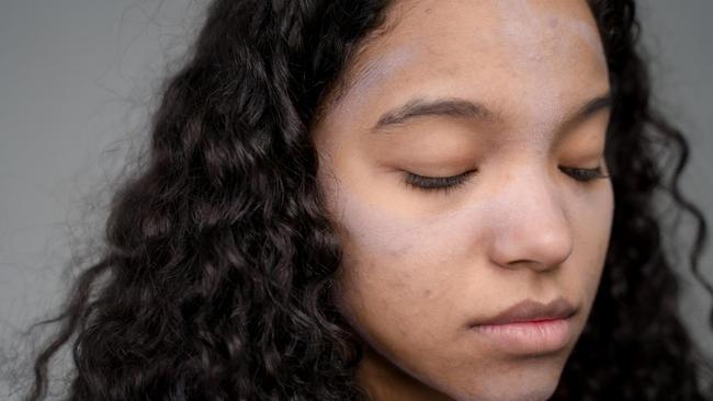 4 Cara Merawat Kulit Wajah Bruntusan dan Banyak Komedo, Cukup Lakukan ...