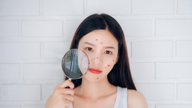 Jerawat nodul: Ciri-ciri dan cara menghilangkannya