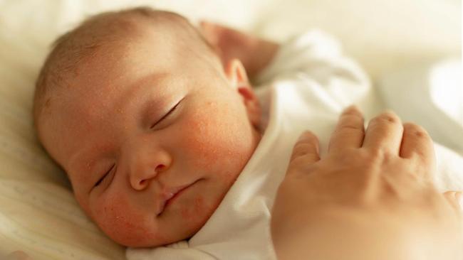 Bintik Merah pada Bayi: Ketahui Gejala, Penyebab, dan Kapan Harus ke Dokter