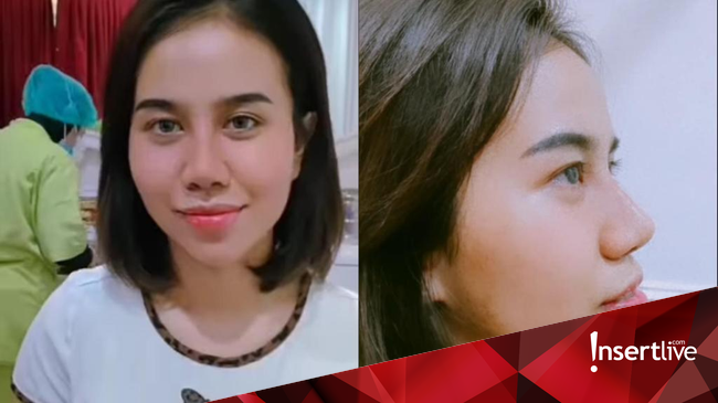 Potret Hidung Baru Mayang Setelah Lepas Perban Operasi