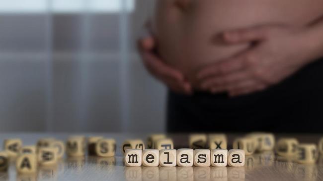 Melasma saat Hamil: Penyebab dan Cara Mengatasi Kulit Hitam saat Hamil