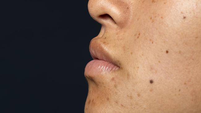 5 Penyebab Munculnya Bintik Hitam di Wajah dan Cara Mudah Mengatasinya