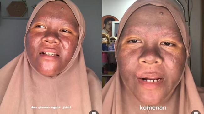 Cerita Wanita Kaltim Wajahnya Gosong Usai Pakai Krim Wajah, Awalnya ...