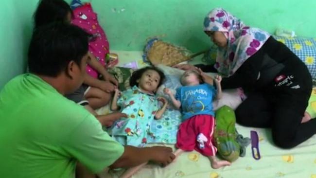 Nasib Malang 2 Anak Buruh Harian Pasar Alami Penyakit Lumpuh Otak