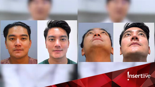 Before-after Boy William yang Oplas Hidung