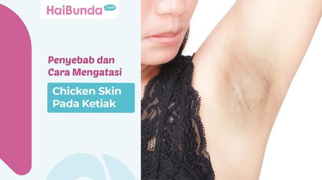 Penyebab dan Cara Mengatasi Chicken Skin Pada Ketiak