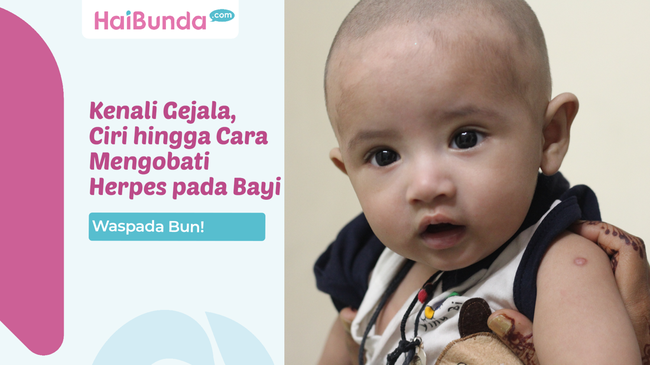 Waspada Bun! Kenali Gejala, Ciri hingga Cara Mengobati Herpes pada Bayi