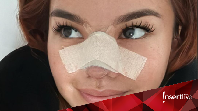 Shafa Harris Ungkap Kondisi Terkini setelah Jalani Operasi Plastik di ...