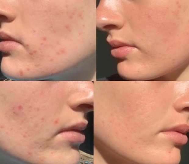 Mulai dari Stres dan PMS, Ketahui Penyebab dan Perawatan Jerawat Hormonal Mulai dari Stres dan PMS, Ketahui Penyebab dan Perawatan Jerawat Hormonal