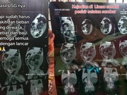 Berita dan Informasi Fetus in fetu adalah Terkini dan Terbaru Hari ini ...