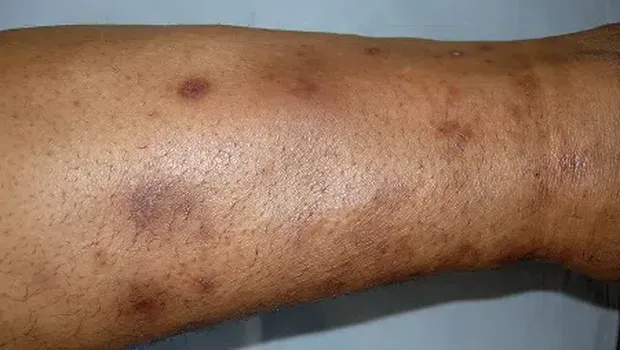 Leher Hitam Bukan Karena Daki, Bisa Jadi Pertanda Sakit Ini