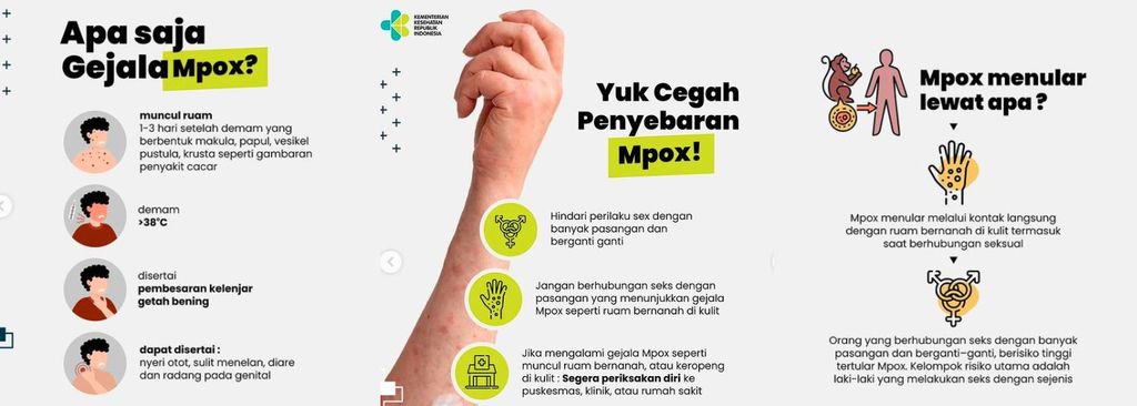 Mpox Masih Tahap Epidemi: Apa Artinya dan Cara Mencegahnya