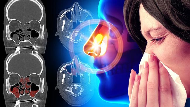 Depresi Akibat Masalah Sinus Ganggu Produktivitas