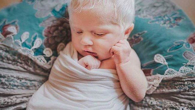 Nora, si Bayi Elsa 'Frozen' yang Berambut Putih karena Albino - Foto 1