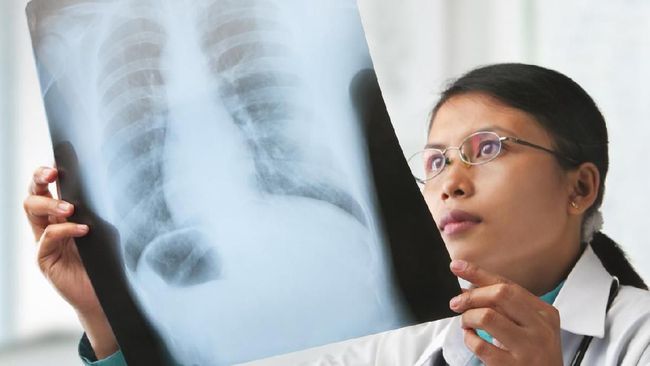 Terungkap, Hasil Rontgen Paru Pasien COVID-19 Alami Batuk selama 3 Minggu