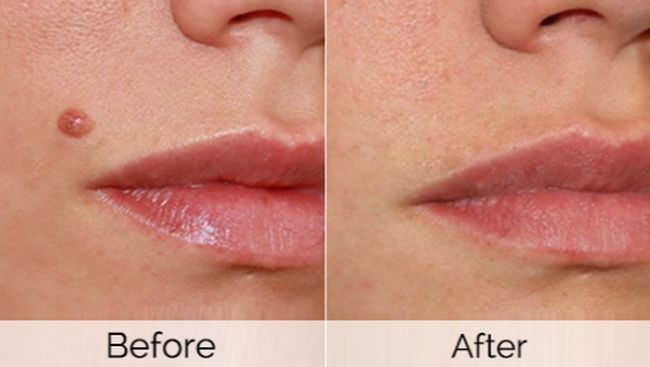 Cara Alami dan Efektif Menghilangkan Kutil pada Kulit