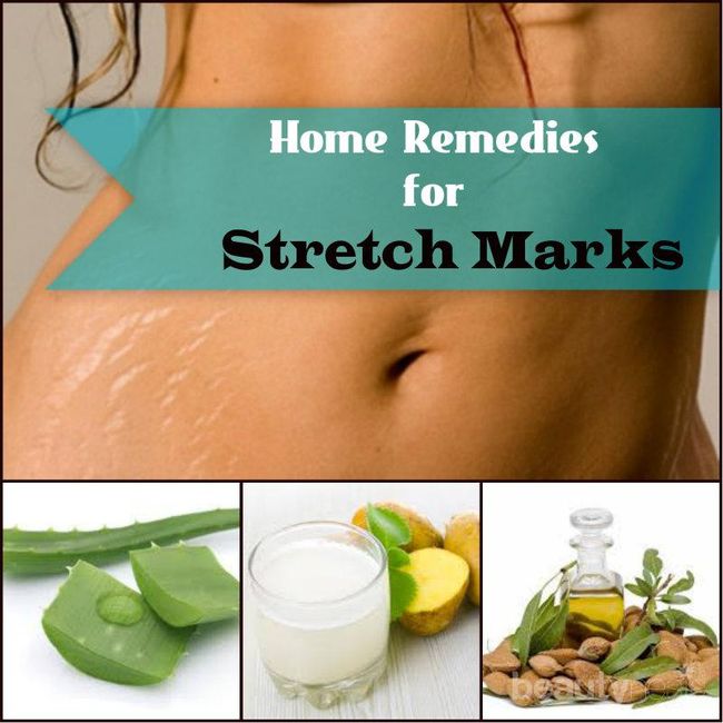 4 Bahan Alami untuk Mengatasi Stretch Mark