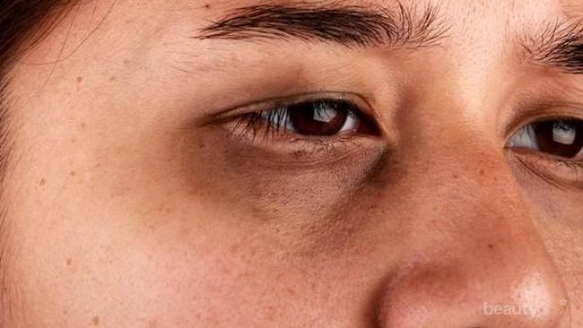 [FORUM] Minta saran buat mengurangi kantong mata setelah begadang dong ...