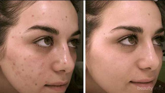 Ladies, 4 Bahan Alami Ini Bisa Hilangkan Noda Hitam di Wajah Sampai Tuntas!