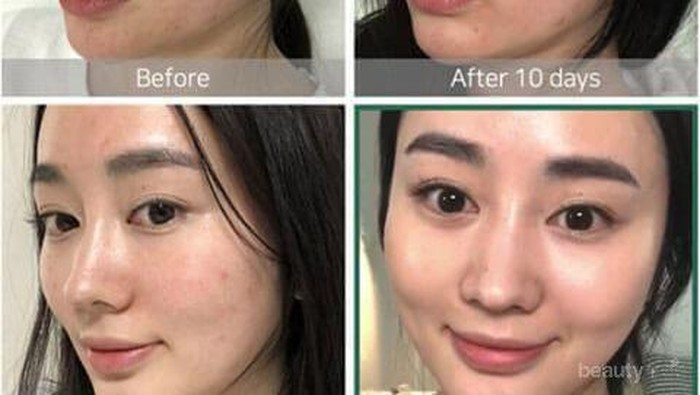 Tak Perlu Facial Mahal, Essence Korea Ini Ampuh Atasi Jerawat dan Bekasnya Tak Perlu Facial Mahal, Essence Korea Ini Ampuh Atasi Jerawat dan Bekasnya