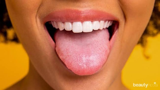 Gejala dan Penyebab Kanker Lidah yang Perlu Kamu Tahu