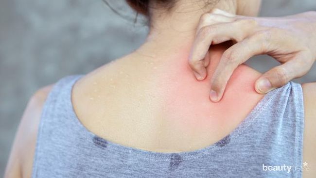 Ampuh Mengatasi Gatal, 5 Rekomendasi Bedak Gatal