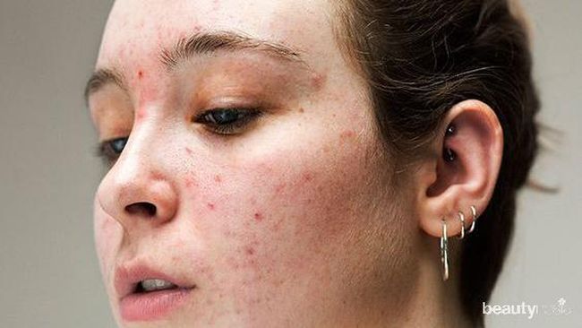 8 Kandungan Skincare yang Mampu Membasmi Jerawat