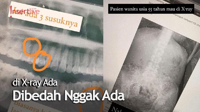 Heboh X-ray Susuk, Pihak Medis: Kadang Suka Pindah Lokasi
