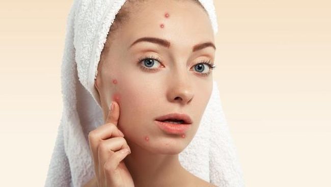 Ampuh Banget! 4 Bahan Alami Ini Hilangkan Bekas Jerawat Membandel