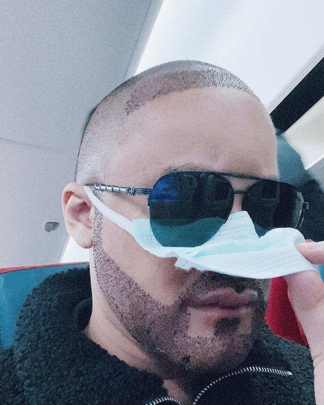 Fakta Cangkok Rambut ala Kevin Aprilio, Benarkah Bikin Subur?