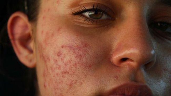 Jenis-jenis Jerawat dan Cara Mengatasinya