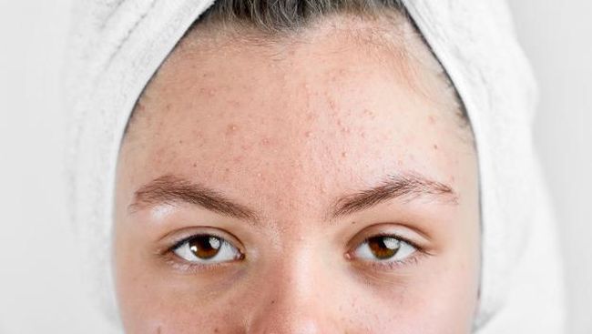 Kesalahan Saat Menggunakan Skincare yang Bisa Membuat Kulit Breakout ...