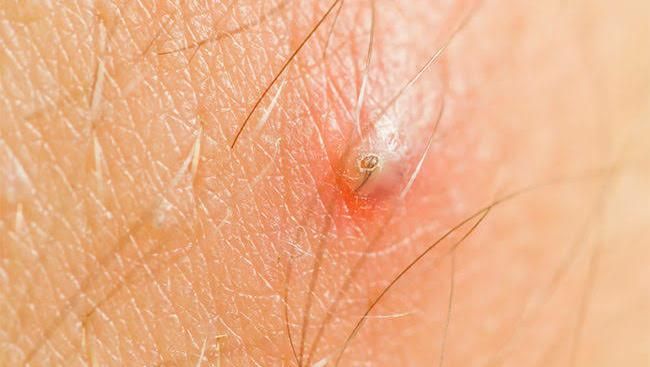Ingrown Hair: Rambut yang Tumbuh ke Dalam Kulit, Berbahayakah?