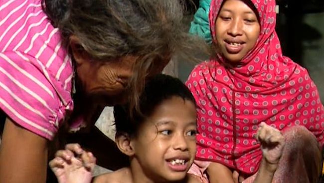 Diikat karena Sering Berguling ke Jalan, Anak Lumpuh Otak Berjuang Sembuh