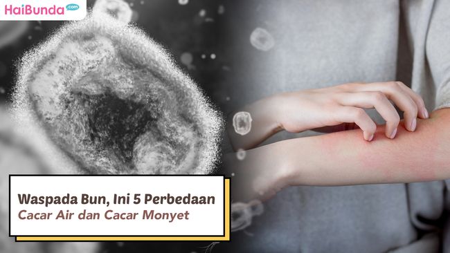 Waspada Bun, Ini 5 Perbedaan Cacar Air dan Cacar Monyet Waspada Bun, Ini 5 Perbedaan Cacar Air dan Cacar Monyet