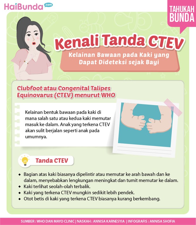 Kenali Tanda CTEV Kelainan Bawaan pada Kaki yang Dapat Dideteksi sejak Bayi