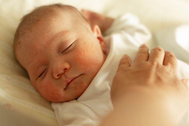 Ruam Kulit Pada Anak Jenis Penyebab Hingga Cara Mengatasinya