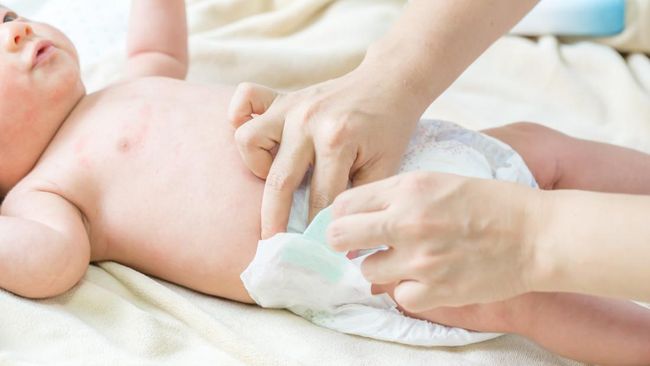 Cara Mengatasi Ruam Popok dengan Tepat, Kapan Harus Dibawa ke Dokter?