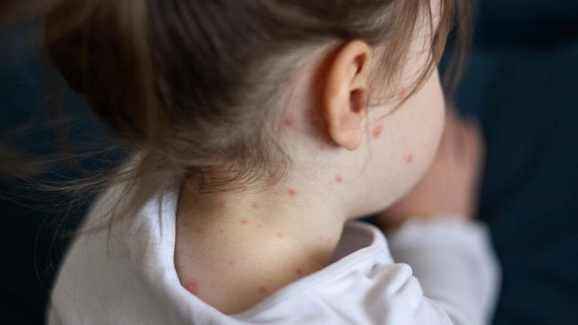 Campak pada Bayi: Jenis, Penyebab, Gejala, Pengobatan & Pencegahan