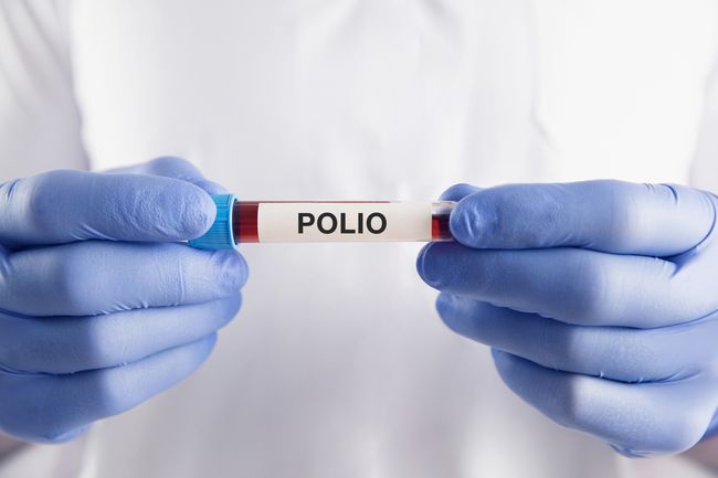 Apakah Polio Bisa Disembuhkan & Ada Obatnya?