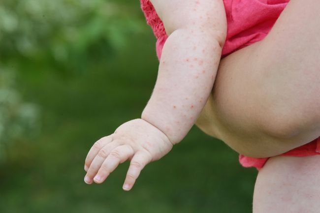 7 Obat Campak Anak Alami dan Tersedia di Apotik