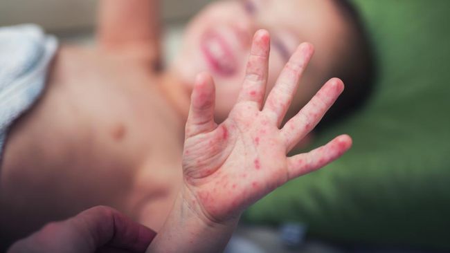 Mengenal Tampek pada Anak dan Bedanya dengan Campak, Penyebab Ruam ...