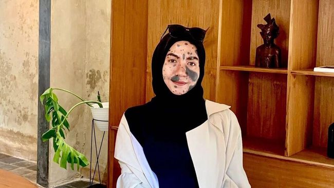 Kisah Wanita Punya Banyak Tanda Lahir Ditolak Keluarga Kekasih ...