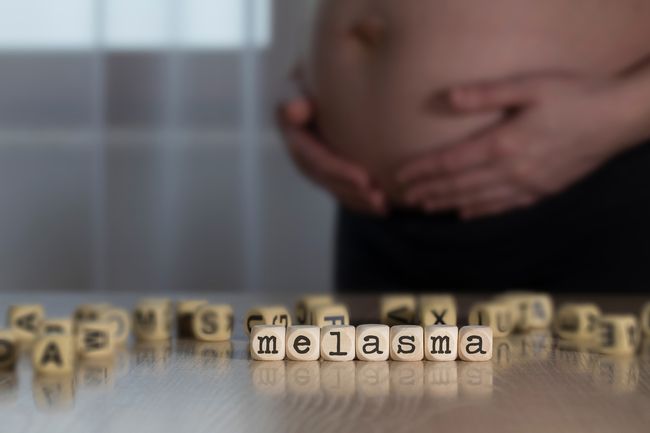Melasma saat Hamil: Penyebab dan Cara Mengatasi Kulit Hitam saat Hamil