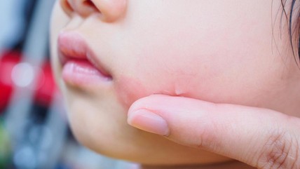 Ruam Kulit pada Anak: Jenis, Penyebab hingga Cara Mengatasinya