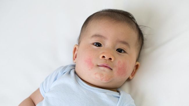 7 Penyebab Bintik Merah pada Anak tapi Tidak Demam dan Cara Mengobatinya