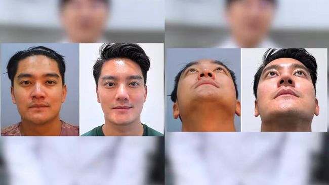 Before-after Boy William yang Oplas Hidung